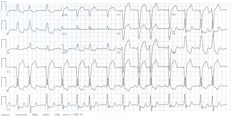 Bundle Branch Block Causes, Symptoms, Diagnosis and Treatment - Natural ...