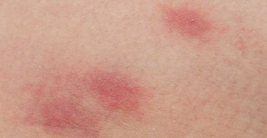 Ehrlichiosis Causes, Symptoms, Diagnosis and Treatment - Natural Health ...